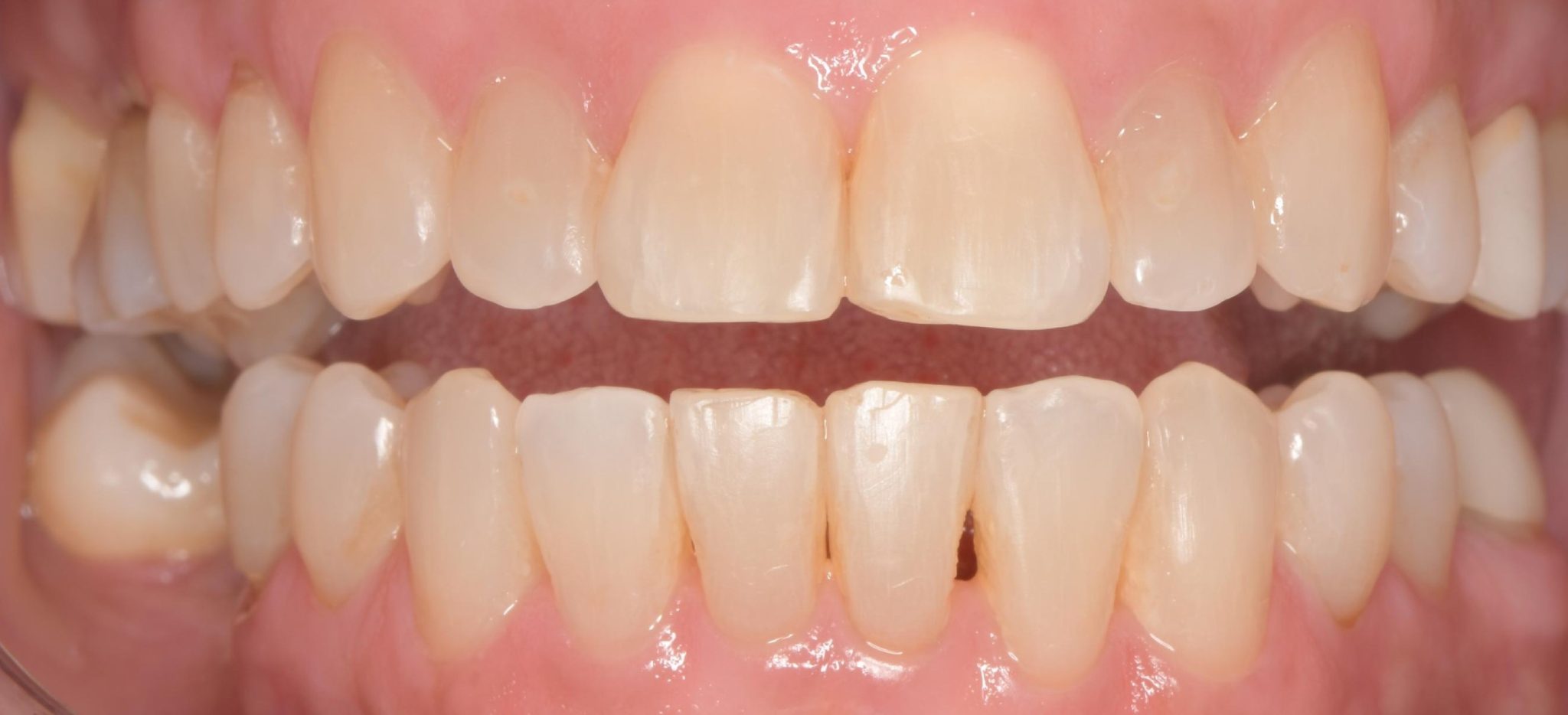 How to Close Black Triangles Between Teeth After Adult Orthodontic ...